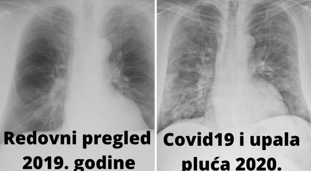 COVID-19 /Korona mu uništila pluća: Prošle godine su bila čista ...